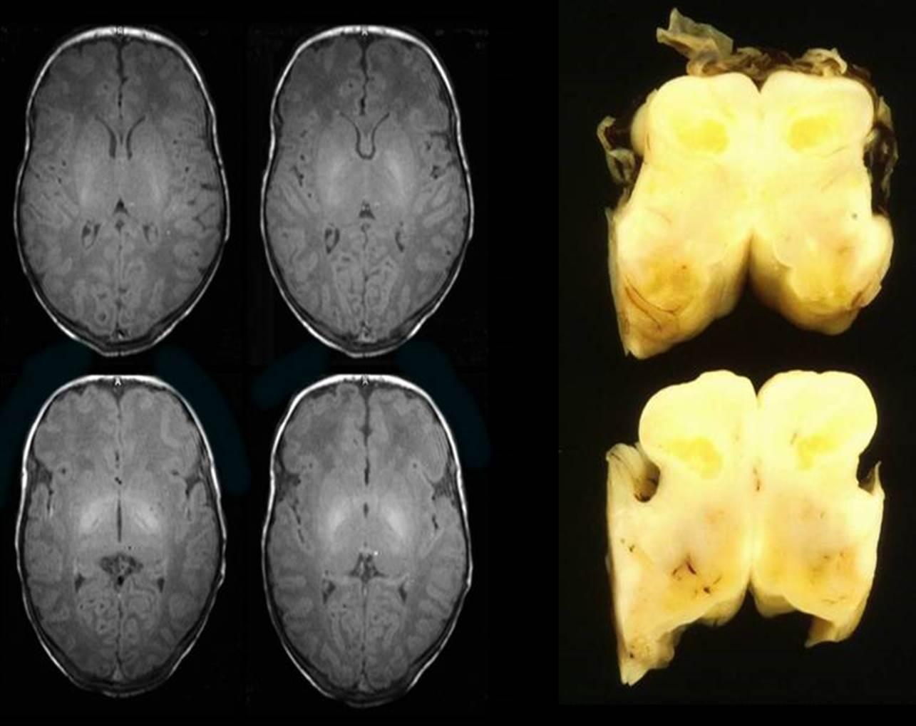 Kispi Wiki :: Hyperbilirubinämie beim Neugeborenen